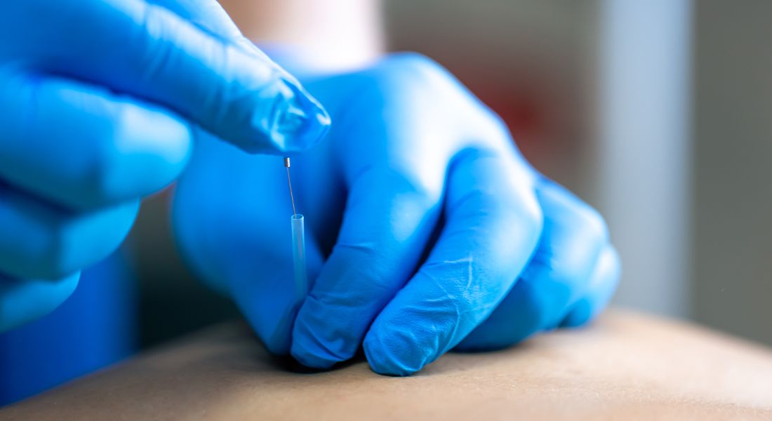 Dry Needling Services in Radford, Va. - Professional Rehab Associates ...
